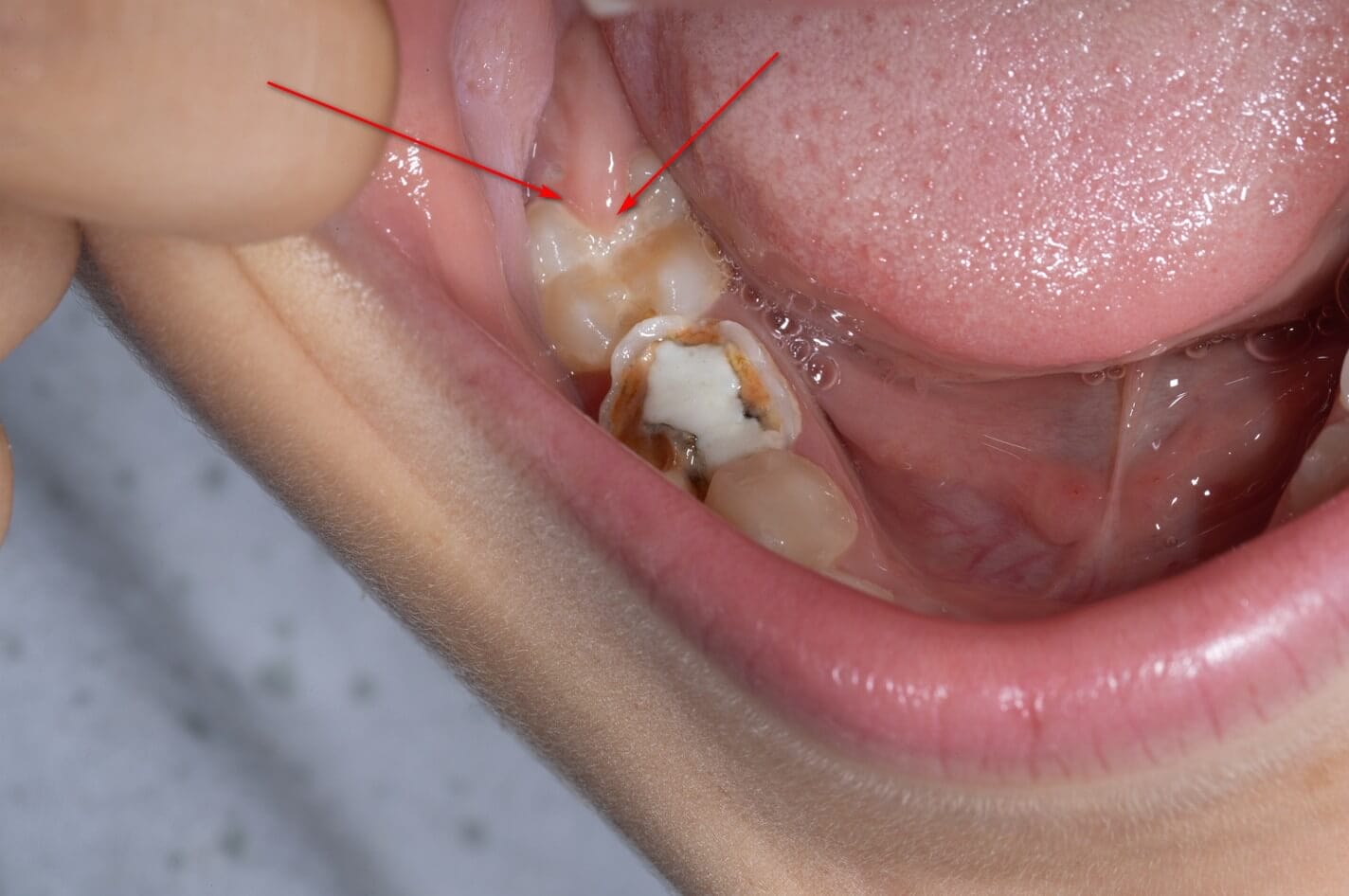 Dental Operculum Pericoronal Flap Removal