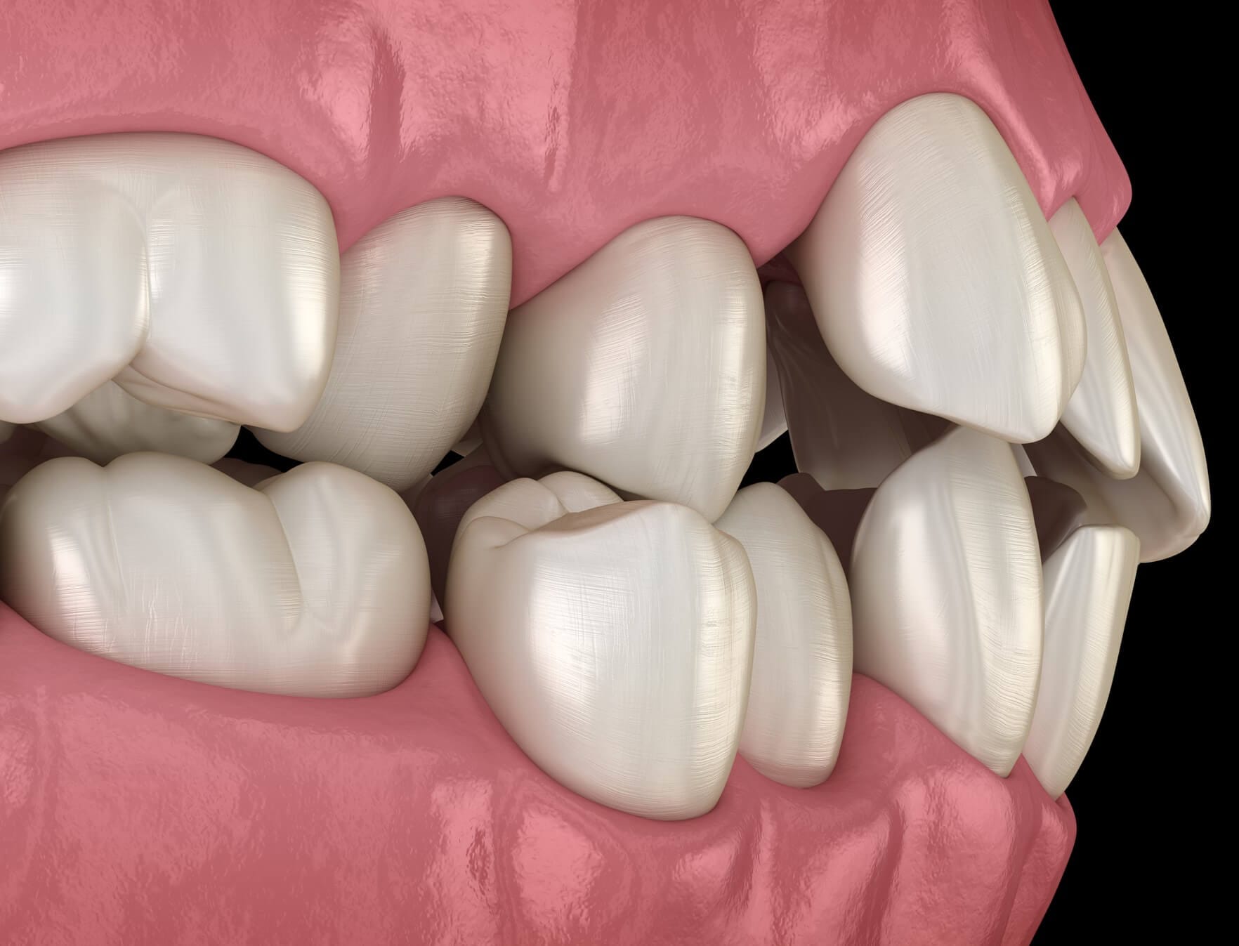 Edge-to-Edge Bite Issues with Invisalign Treatment Correction